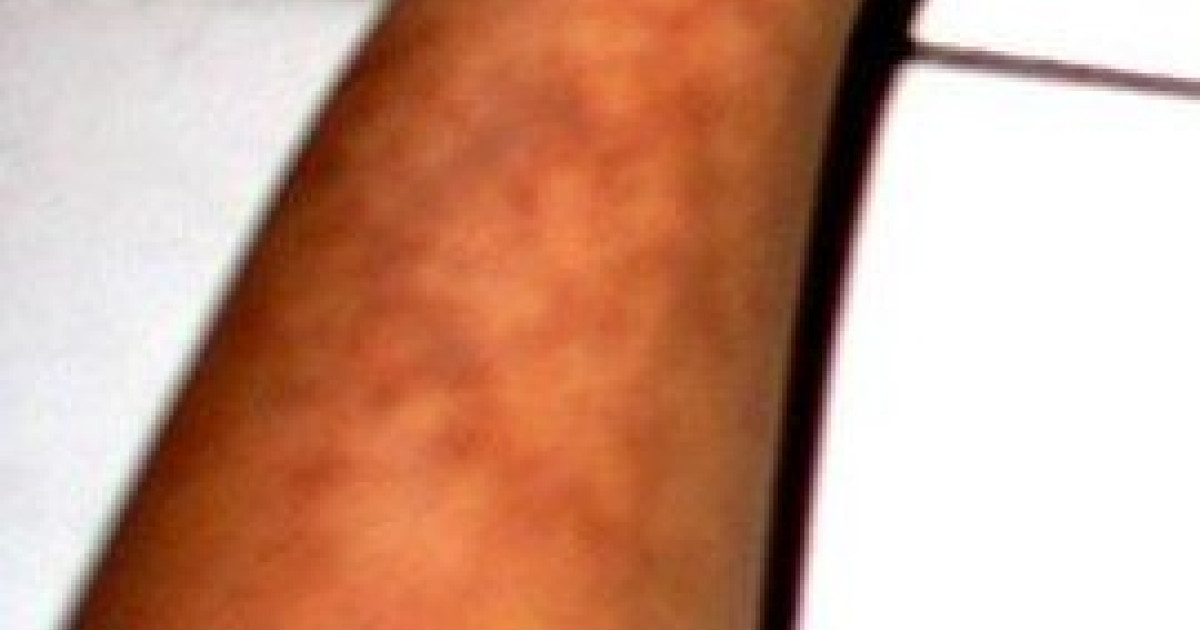 Toasted Skin Syndrome: Η δερματική ασθένεια που προκαλείται από τα laptops!