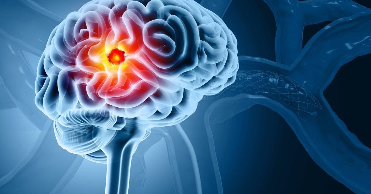 AI μοντέλο ανιχνεύει υπολείμματα όγκων στον εγκέφαλο μέσα σε μόλις 10 ...